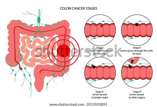 Colorectal Cancer Concept Development Cancer Colon Stock Vector ...