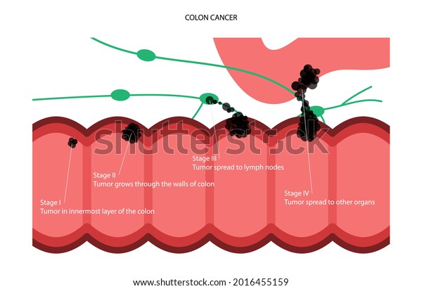 Colorectal Cancer Concept Development Cancer Colon Stock Vector ...