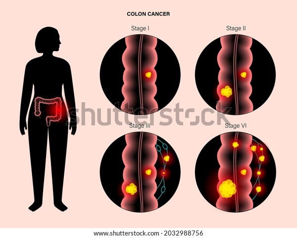 Colorectal Cancer Concept Development Cancer Colon Stock Vector ...