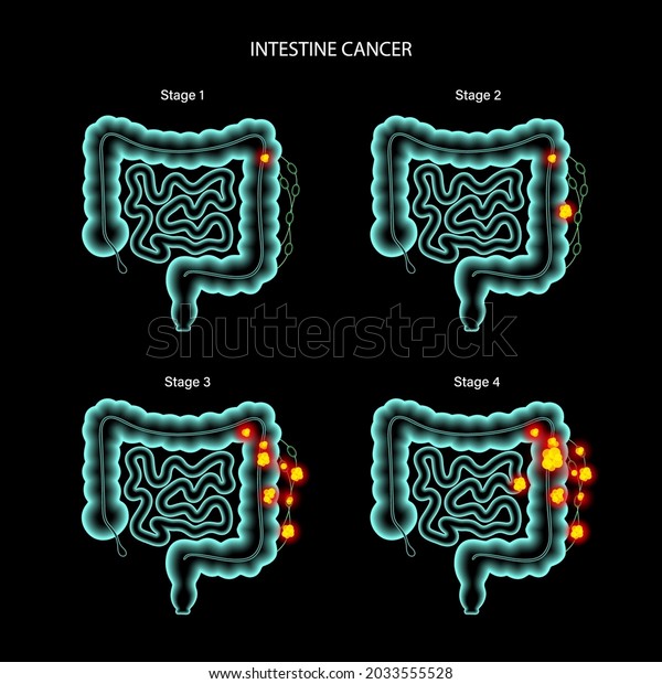 Colorectal Cancer Concept Development Cancer Colon Stock Vector ...