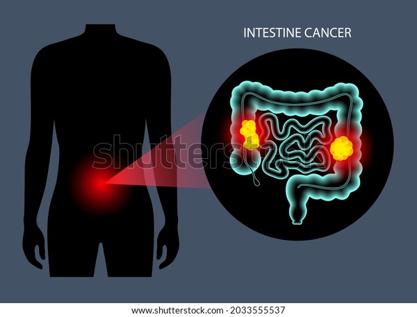 Colorectal Cancer Concept Development Cancer Colon Stock Vector ...