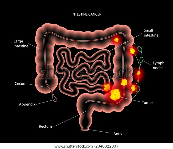 Colorectal Cancer Concept Development Cancer Colon Stock Vector ...