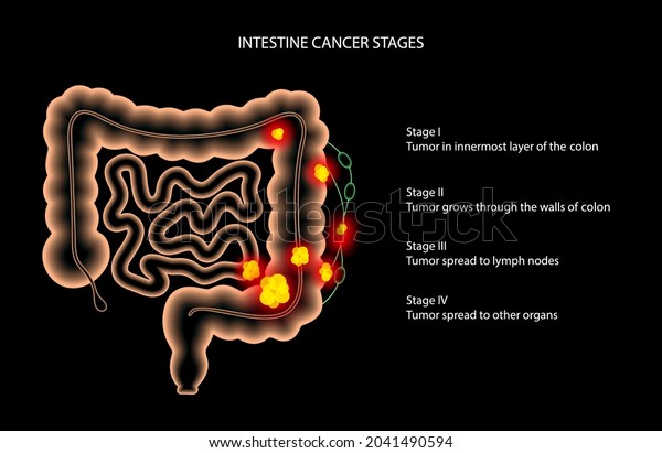 Concepto de cáncer colorrectal. Desarrollo de cáncer desde el colon o ...
