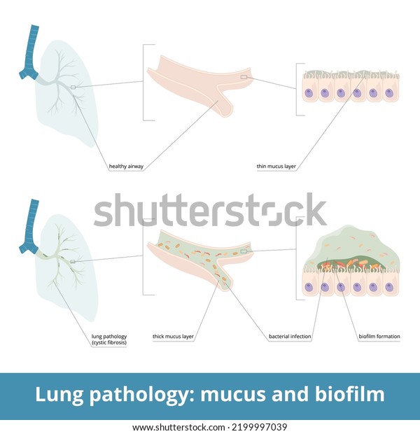 Common Lung Pathology Excessive Mucus Diseases: เวกเตอร์สต็อก (ปลอดค่า ...