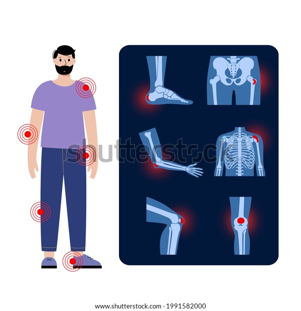 Common Types Bursitis Inflamed Bursa Human Stockvektor (royaltyfri ...