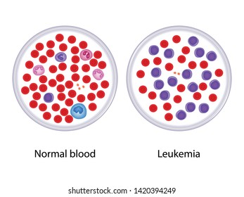 Comparison Between Normal Blood Leukemia Scientific Stock Vector ...
