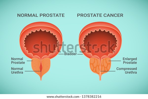 Comparison Healthy Cancer Prostate Vector Illustration: เวกเตอร์สต็อก ...
