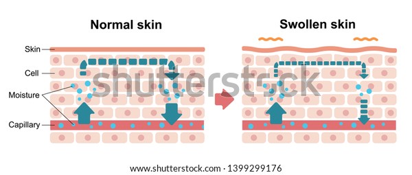 Comparison Illustration Normal Skin Swollen Skin Stock Vector (Royalty ...