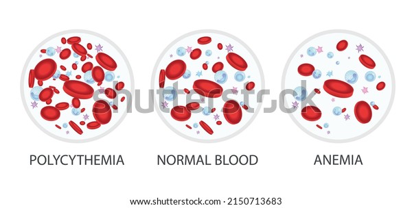 Composition Whole Blood Polycythemia Normal Blood: เวกเตอร์สต็อก (ปลอด ...