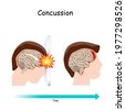 8,080 Concussion Royalty-Free Photos and Stock Images | Shutterstock