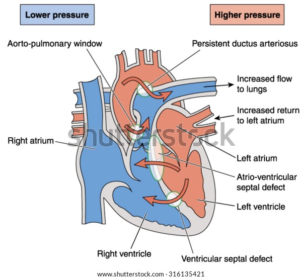 Congenital Heart Defects Resulting Abnormal Blood Stock Vector (Royalty ...