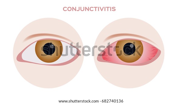 Conjunctivitis Pink Red Inflammation Eye Stock Vector (Royalty Free ...