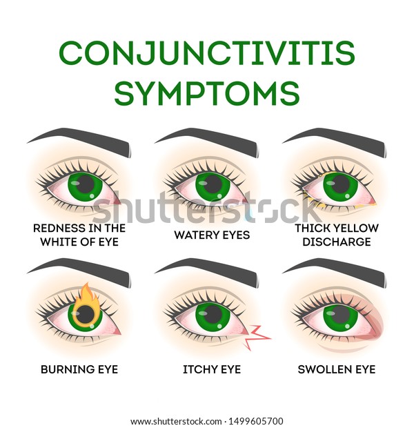 Síntomas De Conjuntivitis Enfermedad Ocular Rosa Vector De Stock