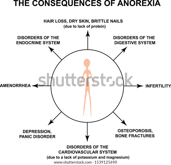 Consequences Anorexia Slim Physique Anorexia Infographics Stock Vector ...