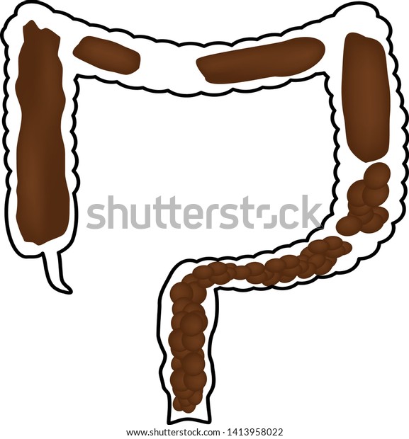 Constipation Feces Colon Infographics Vector Illustration 스톡 벡터(로열티 프리 ...