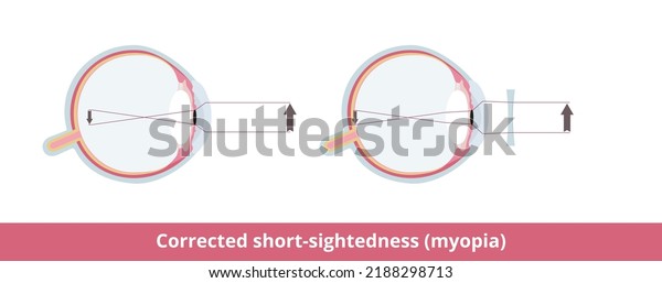 Corrected Shortsightedness Myopia Eye Condition Where Stock Vector ...