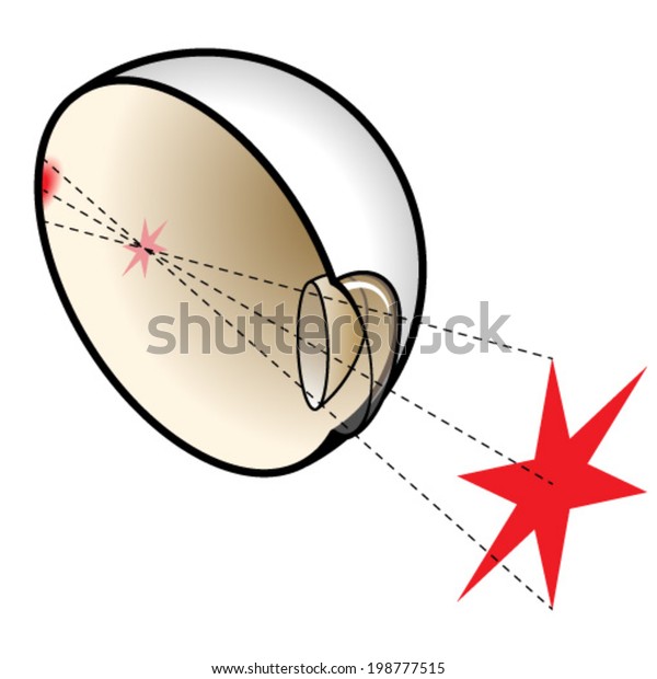 Cross Section Diagram Shortsighted Human Eye Stock Vector (Royalty Free ...
