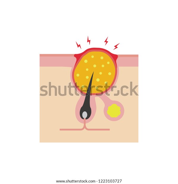 Cross Section Pores Acne Progression Boil: Stock-Vektorgrafik ...