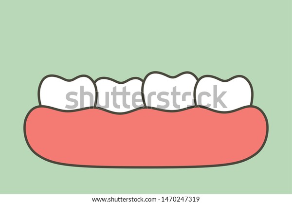 Crowding Teeth Malocclusion Dental Problem Tooth 스톡 벡터(로열티 프리) 1470247319