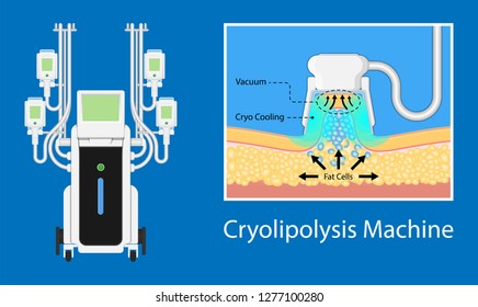 Cryolipolysis Fat Freezing Procedure Cold Treatment Stock Vector ...