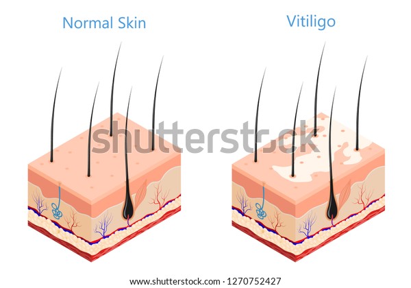 Cut Human Skin Isometric Style On Stock Vector (Royalty Free ...