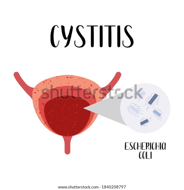 Cystitis Escherichia Coli Bladder Disease Urology 库存矢量图（免版税）1840208797 ...