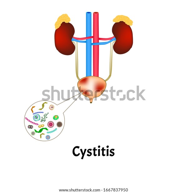 Cystitis Inflammation Bladder Structure Kidneys Bladder Stock Vector ...