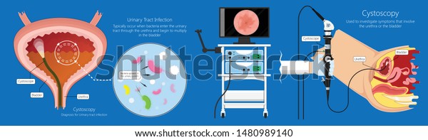 Cystoscopy diagnose bladder diseases and conditions exam treat benign ...