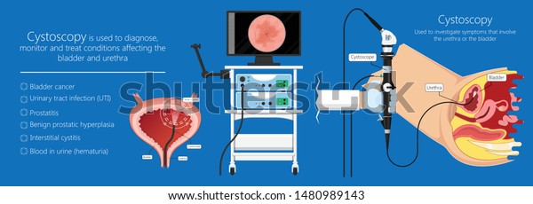 Cystoscopy Diagnose Bladder Diseases Conditions Exam Stock Vector ...