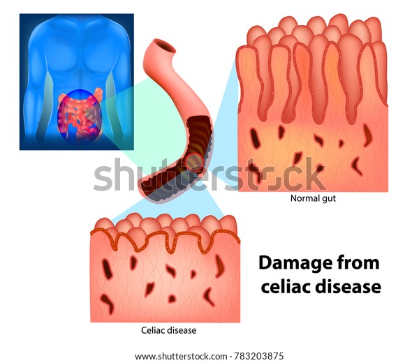 Damage Celiac Disease Celiac Disease Normal Stock Vector (Royalty Free ...