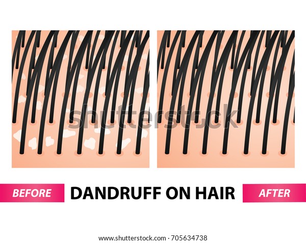 Dandruff On Hair Before After Vector Stock Vector (Royalty Free ...