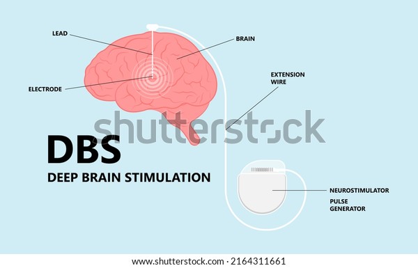 Deep Brain Stimulation Dbs Treat Parkinsons Stock Vector (Royalty Free ...