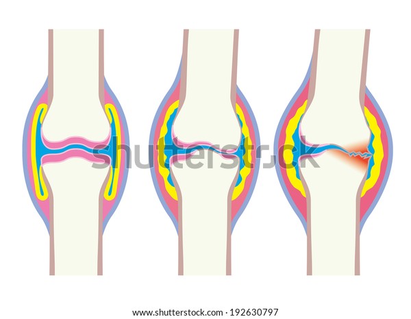 Deformation Process Joint Stock Vector (Royalty Free) 192630797 ...