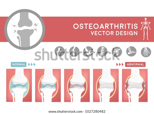 Degenerative Osteoarthritis Flat Cartoon Vector Design Stock Vector ...