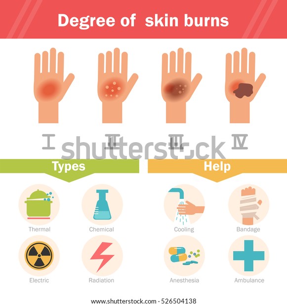 Degree Skin Burns Vector Cartoon Isolated Stock Vector (Royalty Free ...