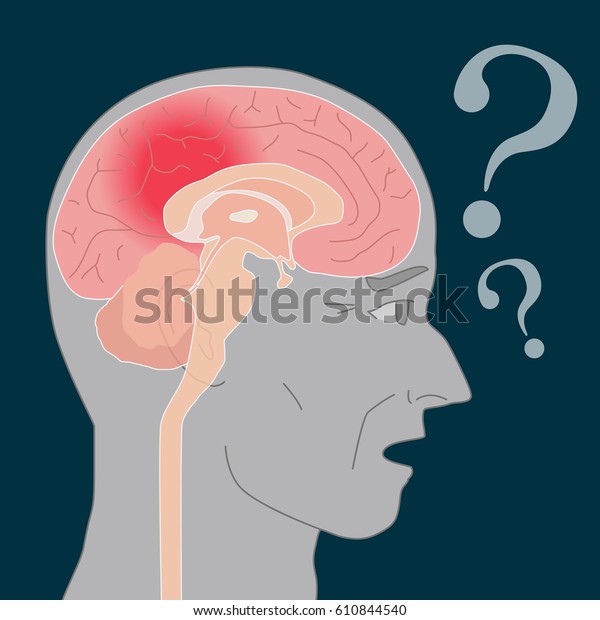 Dementia Aged Person Structure Human Brain Stock Vector (Royalty Free ...