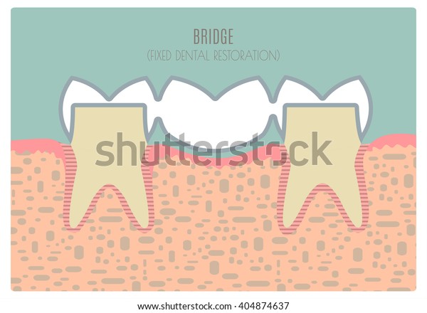 Dental Bridge Vector Illustration All Objects Stock Vector (Royalty ...