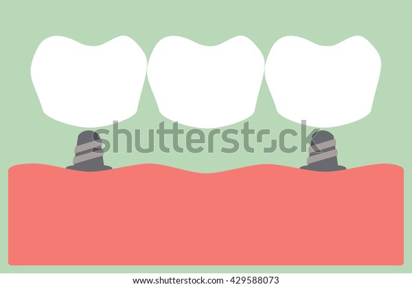 Dental Cartoon Vector Dental Bridge Stock Vector (Royalty Free ...