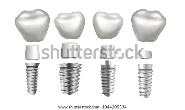 Dental Implant Set Vector Implant Structure Stock Vector (Royalty Free ...