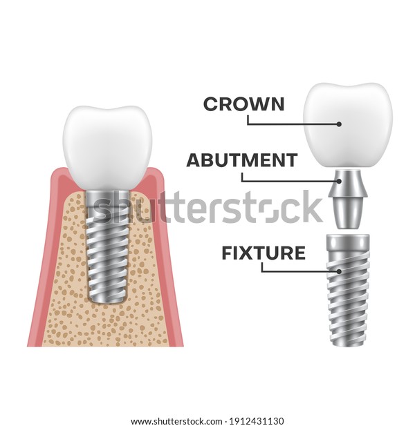 Dental Implant Structure Realistic Schematic Implantation: Vector có ...