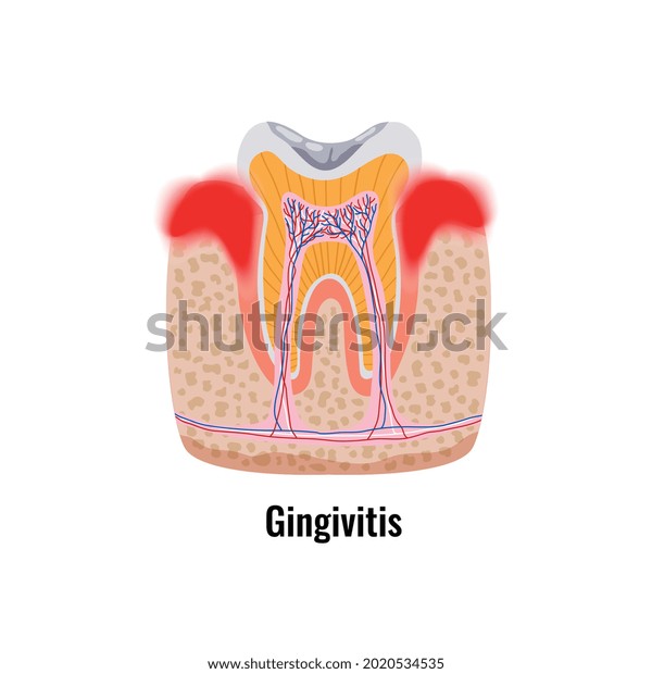 Dental Oral Problems Poster Gingivitis Tooth Stock Vector (Royalty Free ...