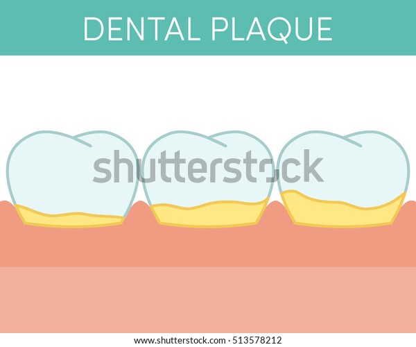 Dental Plaque Concept Vector Illustration Human Stock Vector (Royalty ...