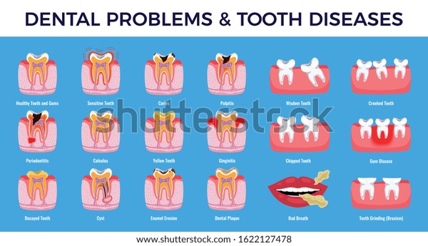 Dental Problems Educational Infographic Info Chart Stock Vector ...