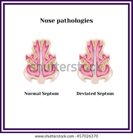 Deviated Septum Nasal Pathology Stock Vector (Royalty Free) 457026370 ...