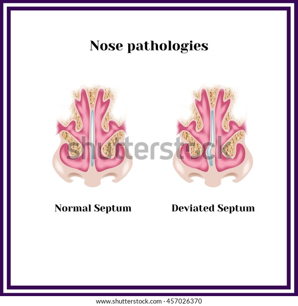 Deviated Septum Diagram