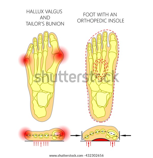 Deviation First Fifth Metatarsals Transverse Flatfoot Stock Vector ...