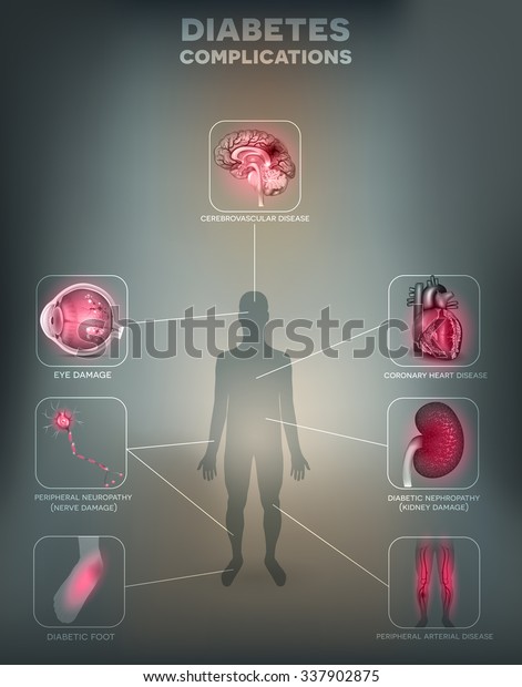 Diabetes Affected Organs On Abstract Grey Stock Vector (Royalty Free ...