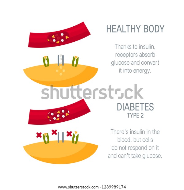 Diabetes Type 2 Concept Diagram Medical Stock Vector (Royalty Free ...