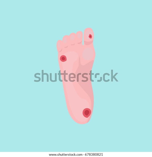 Diabetic Foot Trophic Ulcers Vector Illustration Stock Vector (Royalty ...
