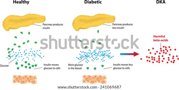 Diabetic Ketoacidosis Stock Vector (Royalty Free) 241069687
